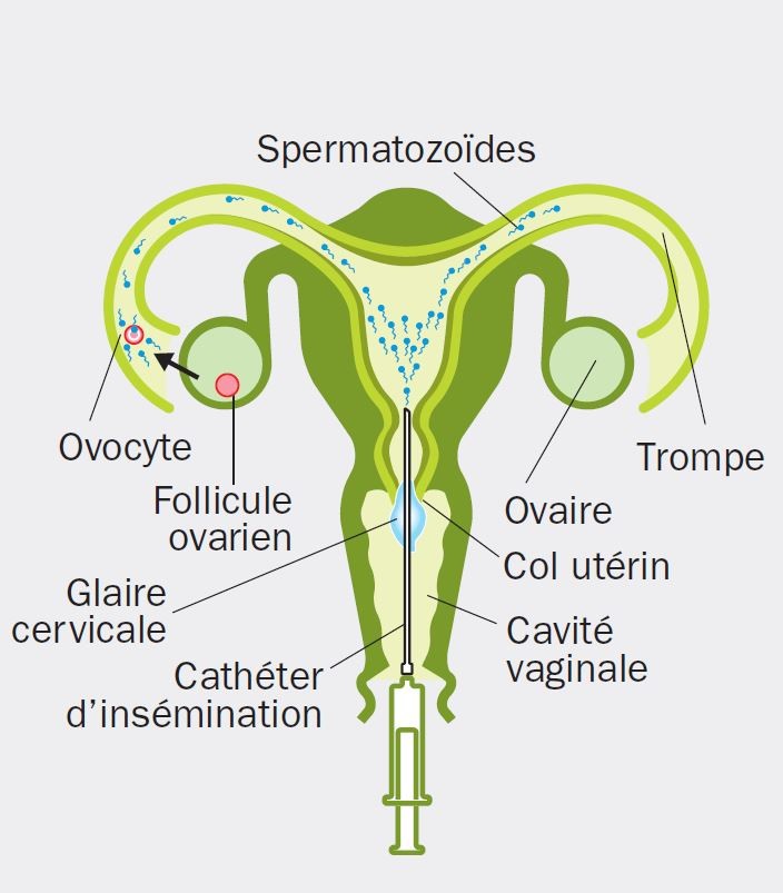 Les différentes techniques d’assistance médicale à la procréation (AMP ...